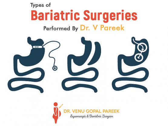 A Guide To Different Types of Bariatric Surgeries Performed