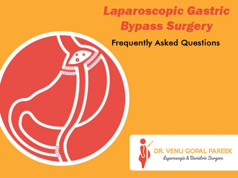 Laparoscopic Gastric Bypass Surgery: Frequently Asked Questions