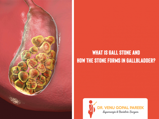 What Is Gall Stone And How Are Stones Formed In Gallbladder?